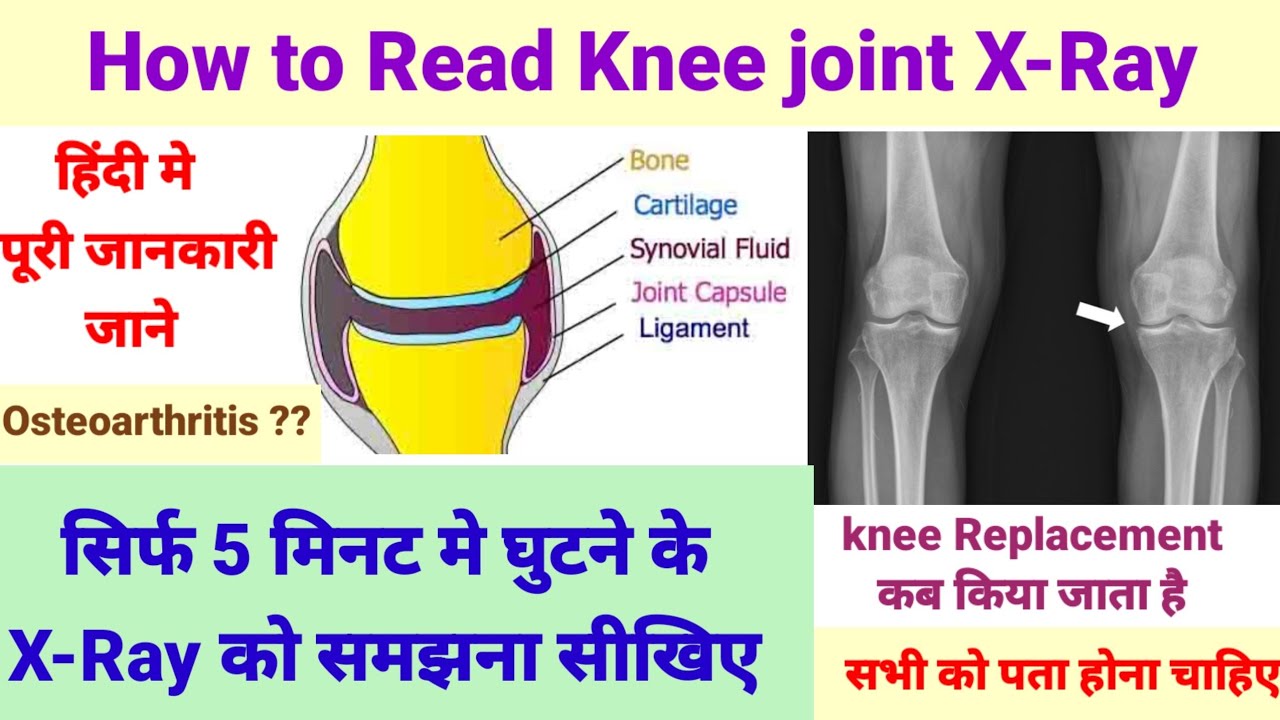 How to read Knee joint x-ray # घुटने के X-Ray को कैसे देखते है। Knee ...