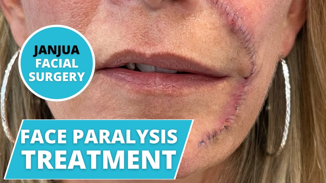 FACIAL PARALYSIS TREATMENT, GIVING HER A SMILE - DR. TANVEER JANJUA ...