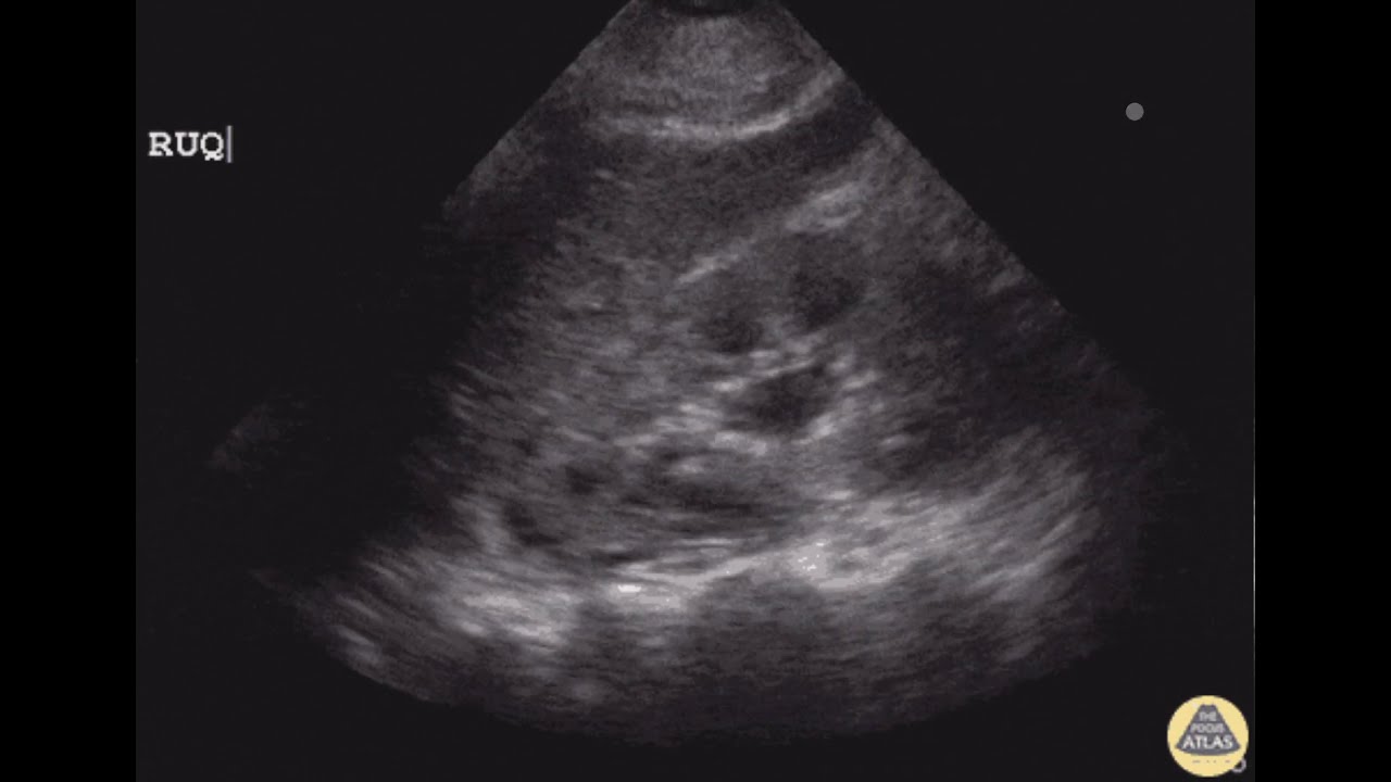 Mild Hydronephrosis from an Ureteral Stone - YouTube