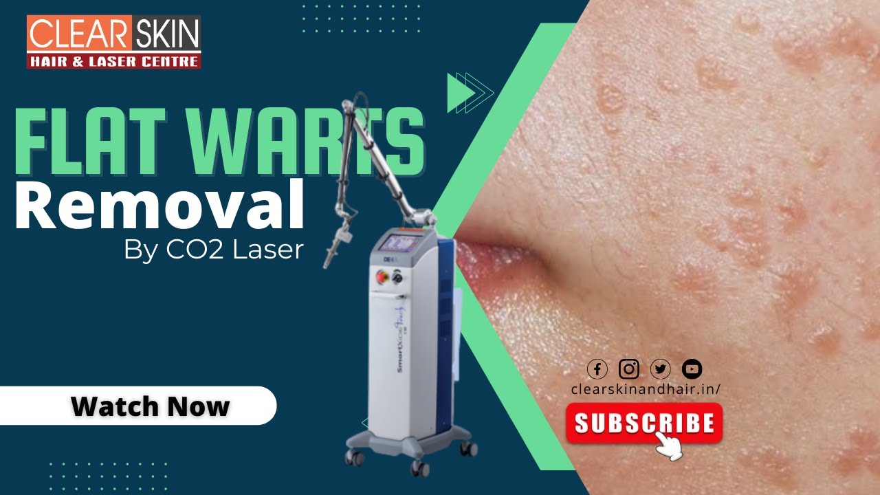 Amazing Ways To Get Rid Of Skin Warts Permanently Co2 Laser