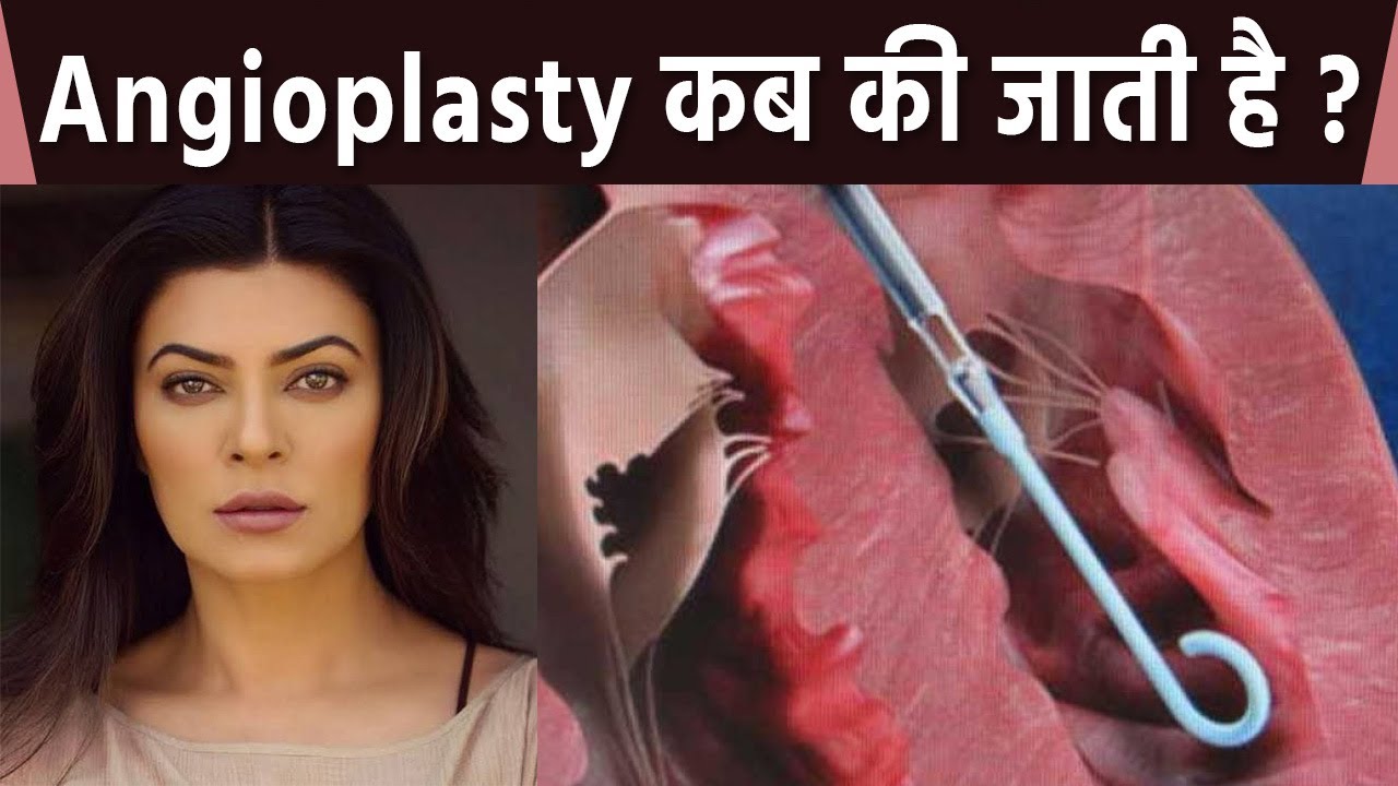 Heart Attack में कब करते हैं Angioplasty, Stunt न डालने पर क्या होता है ...