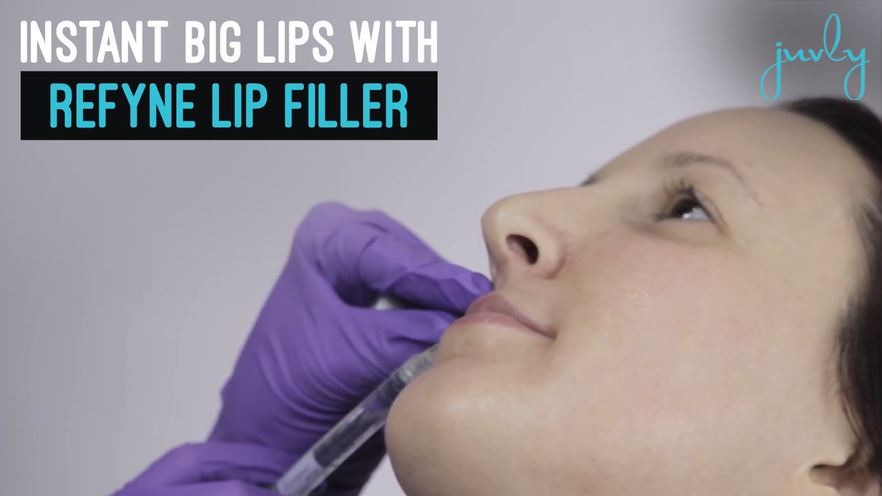 Get Instant Big Lips with Refyne Lip Filler | See the Real Result ...