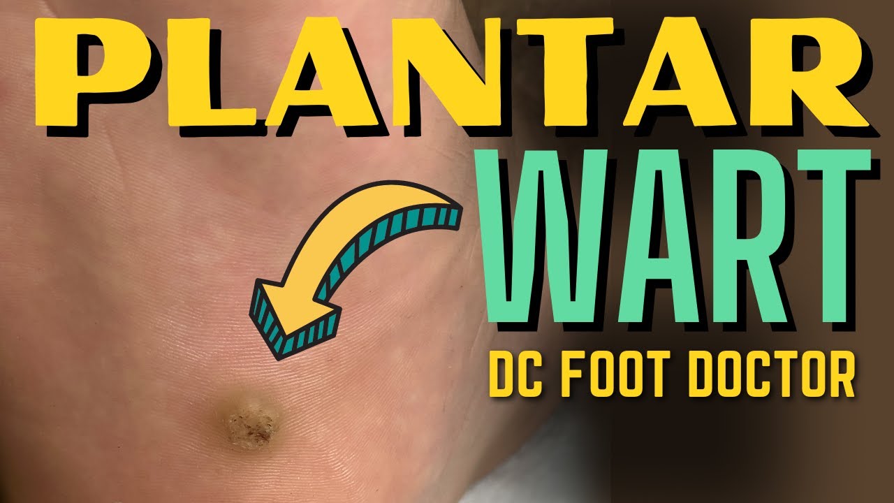 Plantar Wart Verruca Plantaris Youtube