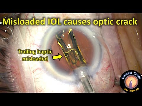 Misloaded IOL causes fractures in the acrylic IOL optic in Cataract ...
