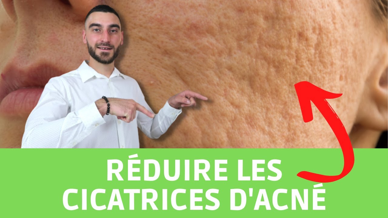 Comment enlever et faire disparaître les cicatrices d'acné - YouTube