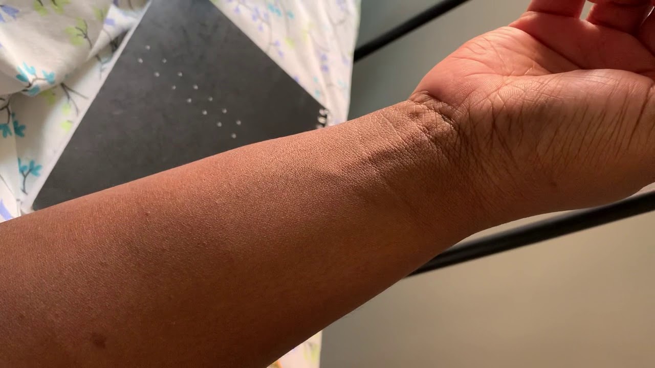 Forearm finger twitch - YouTube