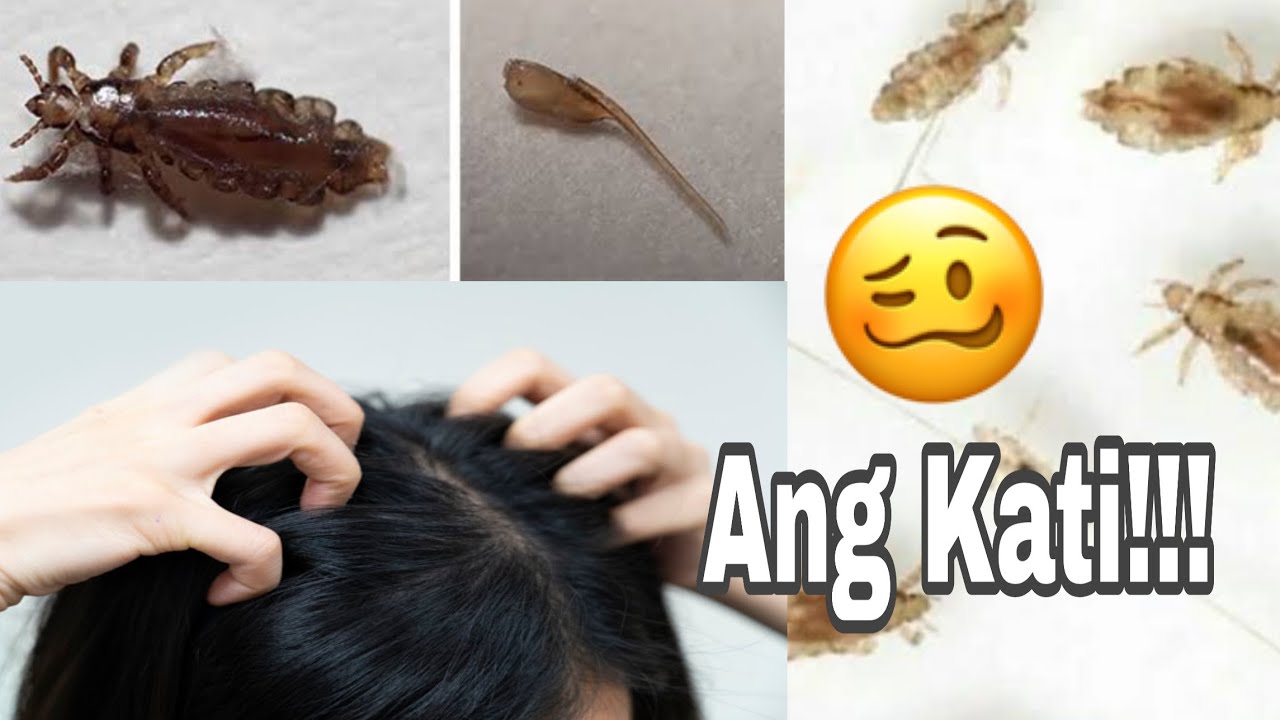 Paano Alisin ang kuto, kuyumad at lisa sa ulo | Blazy Costelo Vlogs ...