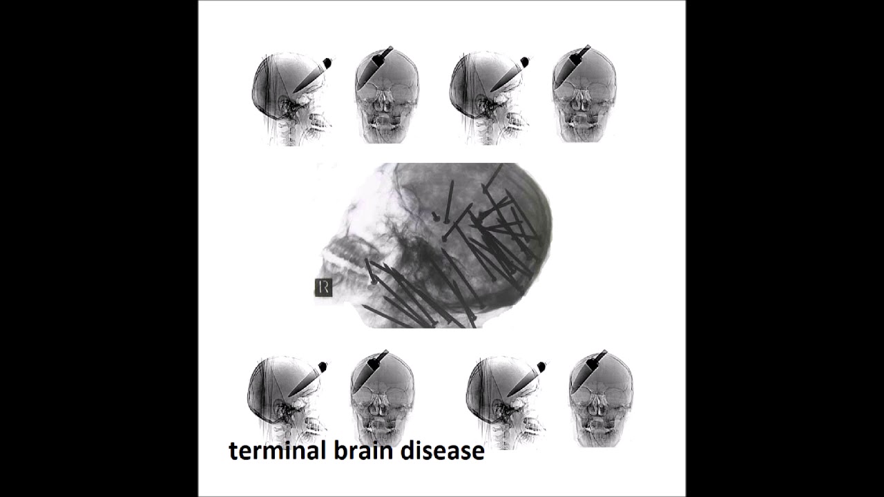 tbd - Terminal Brain Disease - YouTube
