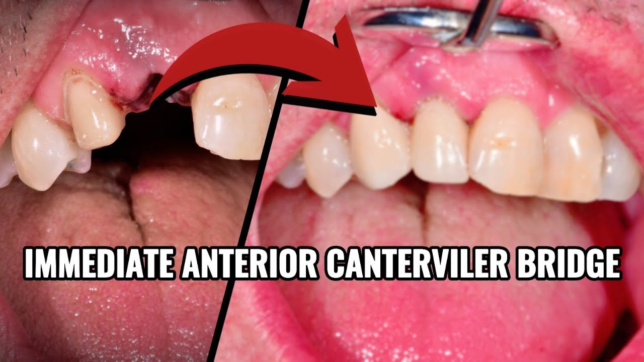 [93] Immediate Canine Cantilever Bridge - YouTube