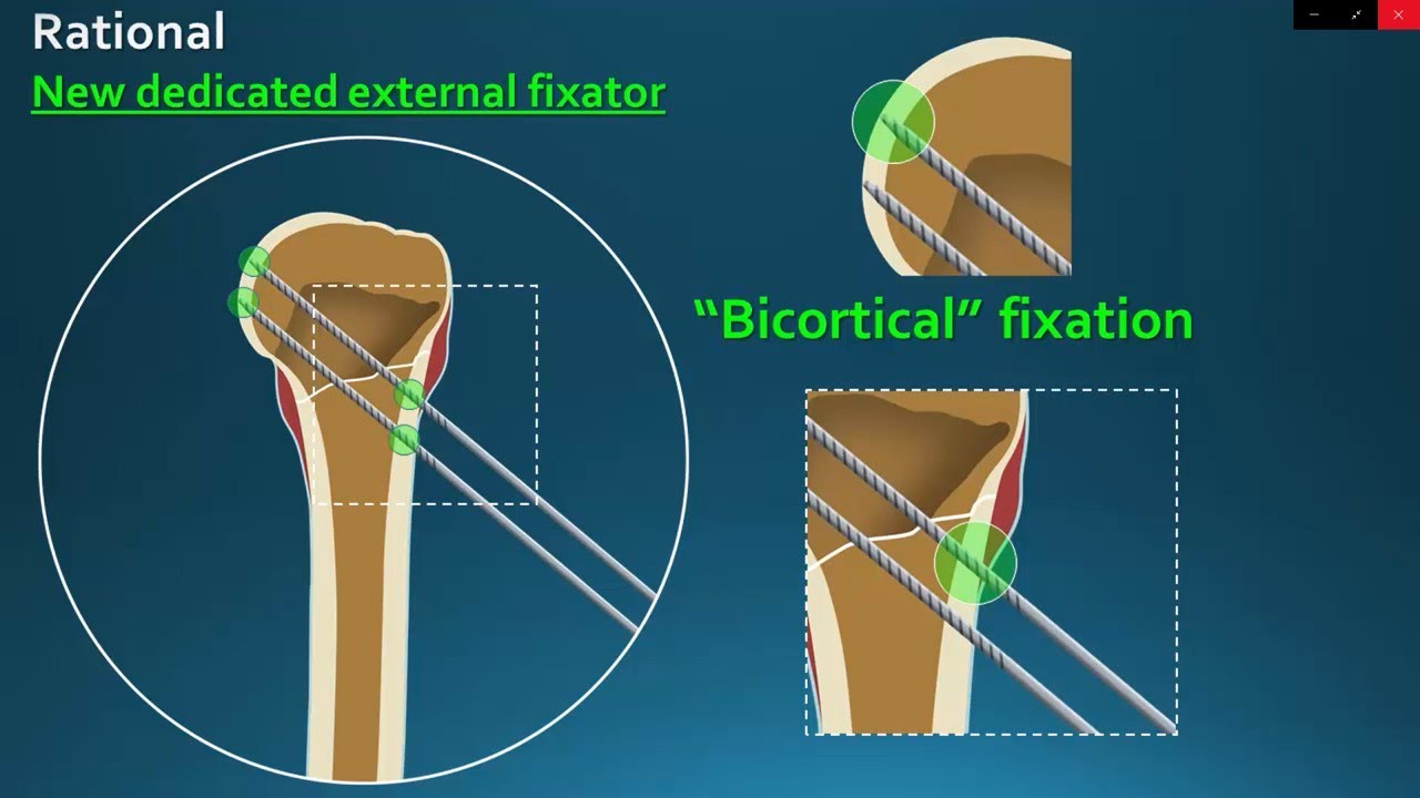 Rational of a dedicated external fixator for the treatment of proximal ...