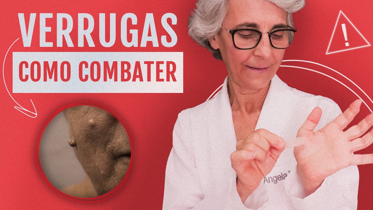 Combata as verrugas de forma simples - YouTube