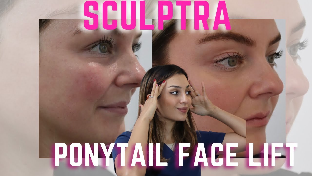 Non surgical Face Lift With SCULPTRA | Fox Eye and SNATCHED look - YouTube