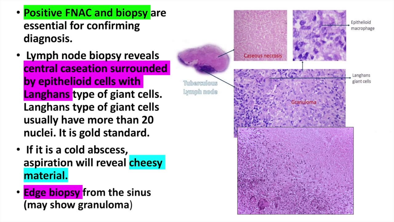 Histopathology Cervical Lymphadenopathy
