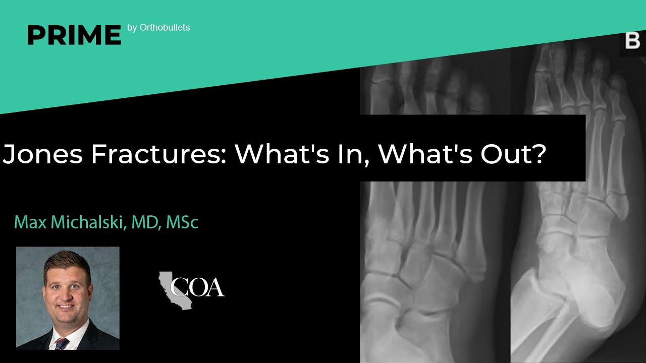 Jones Fractures: What's In, What's Out? - Max Michalski, MD, MSc - YouTube