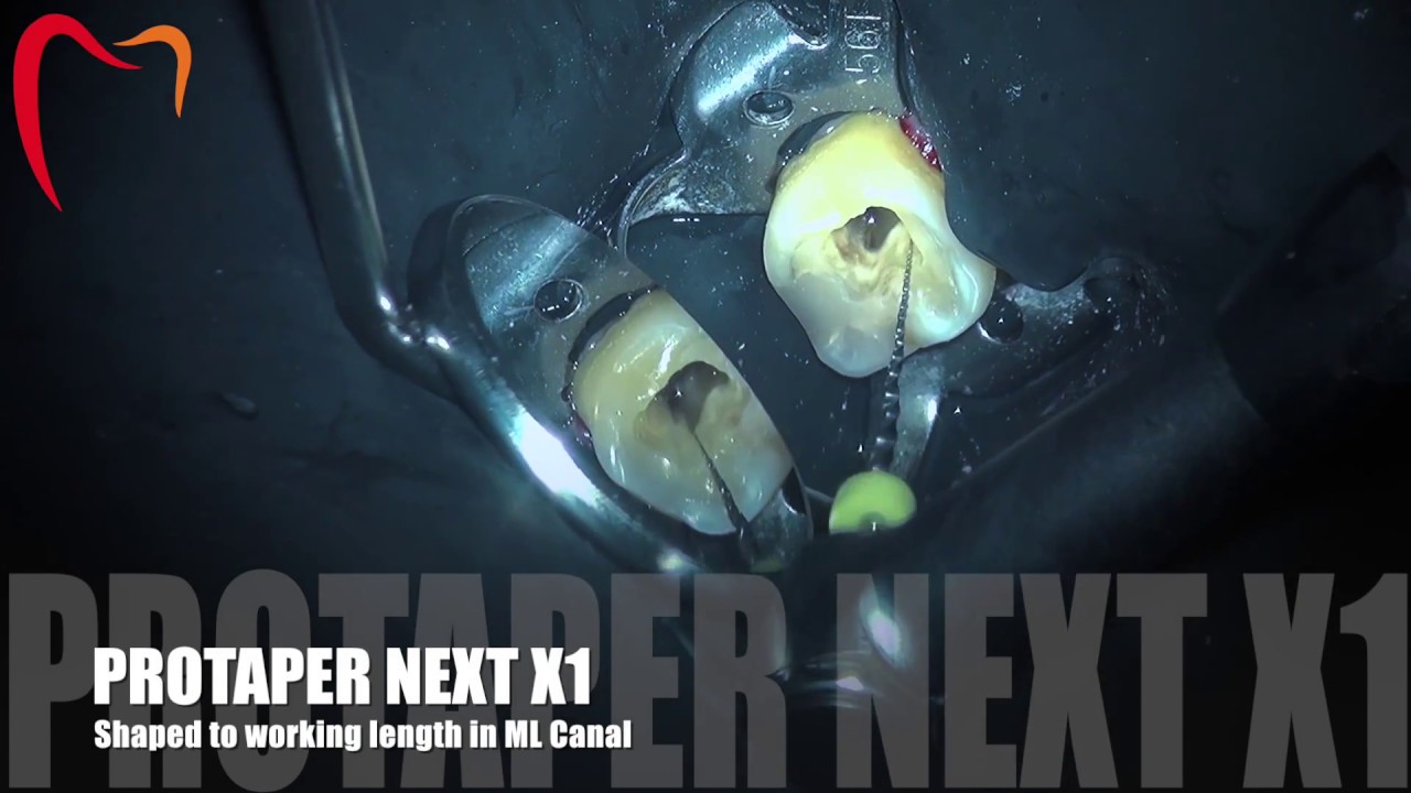 Correct Technique to shape with Rotary Files - YouTube