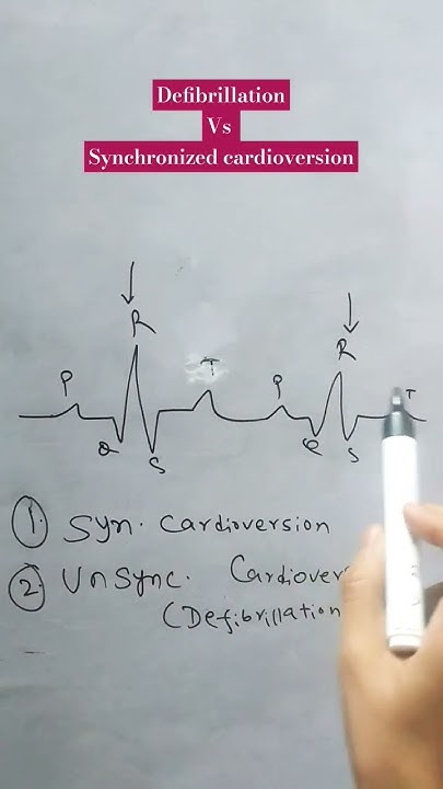 defibrillation vs synchronized cardioversion #defibrillation# ...
