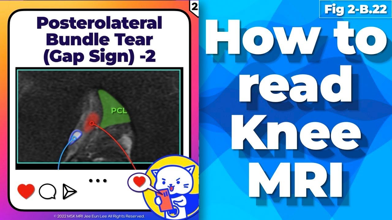 (Fig 2-B.22) Posterolateral bundle tear (Gap sign) -2 - YouTube