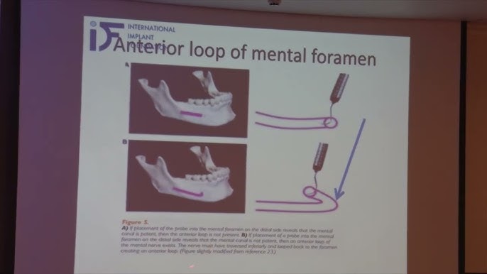 Mental Nerve Loop