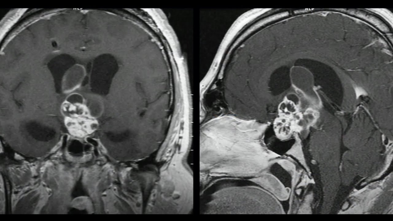 Craniopharyngioma And Pituitary Adenoma