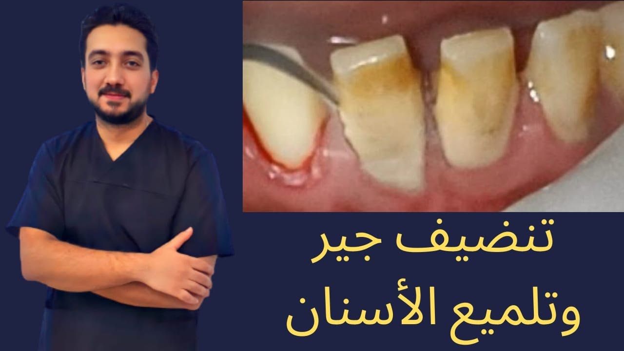 تنضيف جير وتلميع الاسنان لشاب 29 سنه Youtube