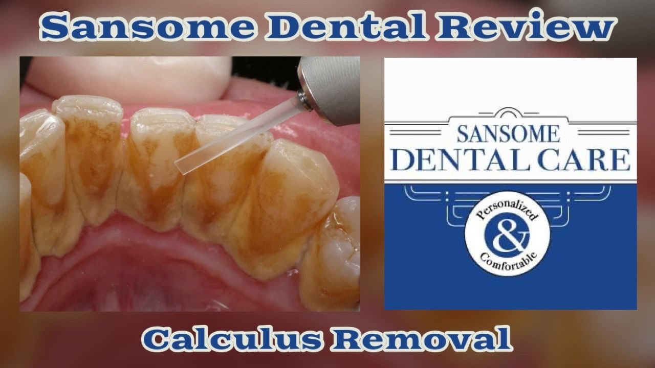 Sansome Dental Review | Calculus Removal - YouTube