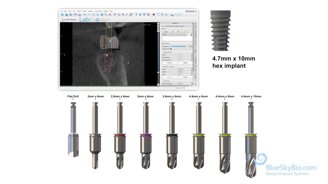 Fully Guided Keyless Hex Implant - YouTube