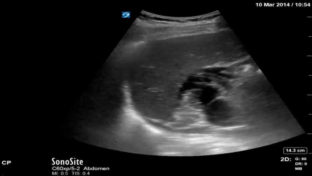 FAST exam - RUQ view - YouTube