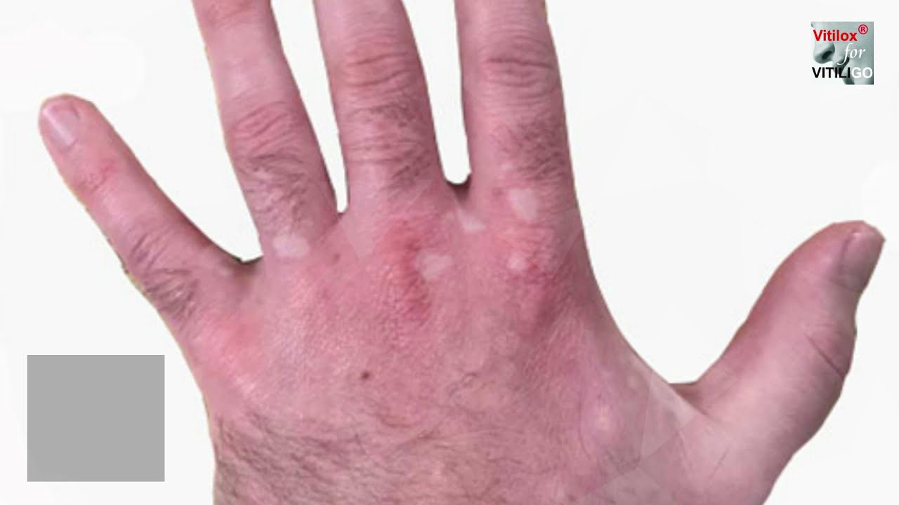 Early Signs of Vitiligo - YouTube