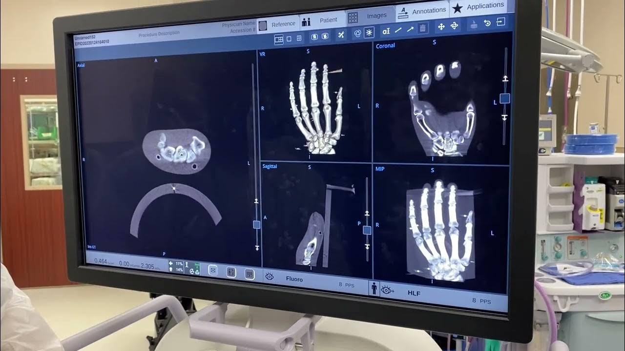 GE OEC 3D C-Arm simple demo - YouTube