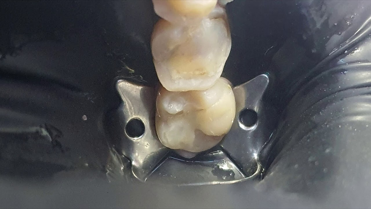 TABLE TOP .. Disilicato de Litio incrustación. - YouTube