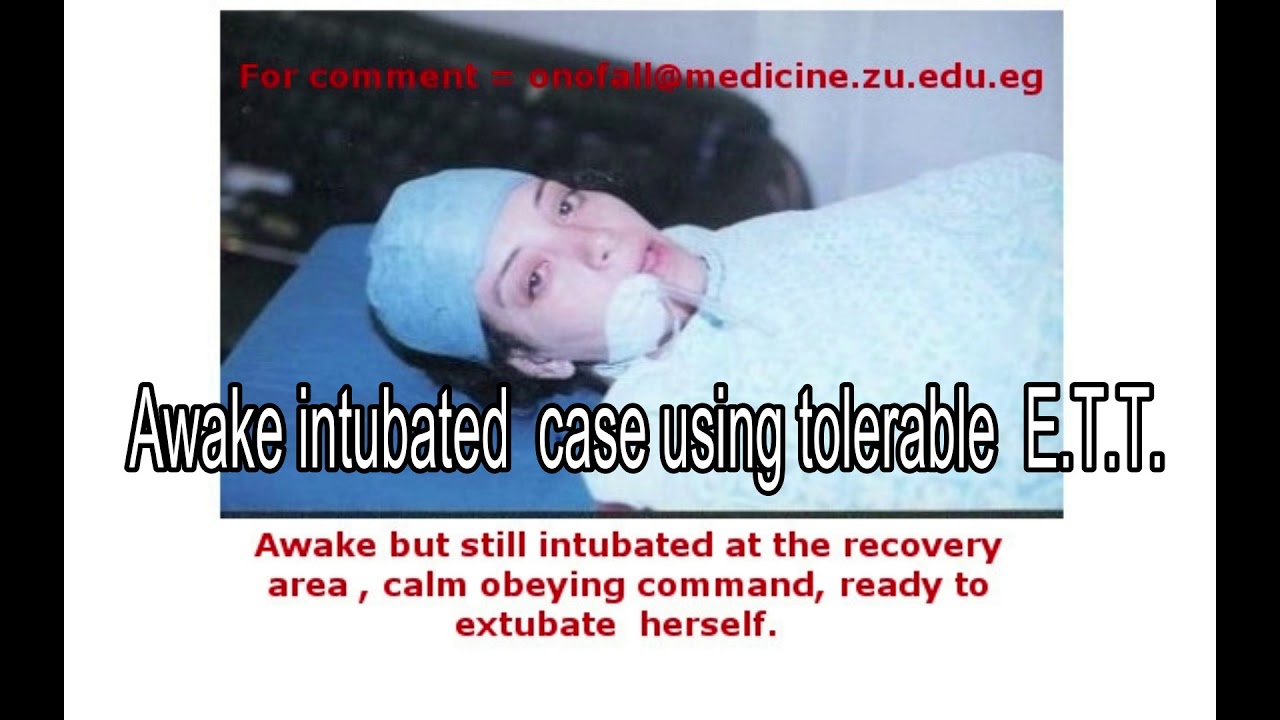 Awake extubation T E T recovery area 2 - YouTube