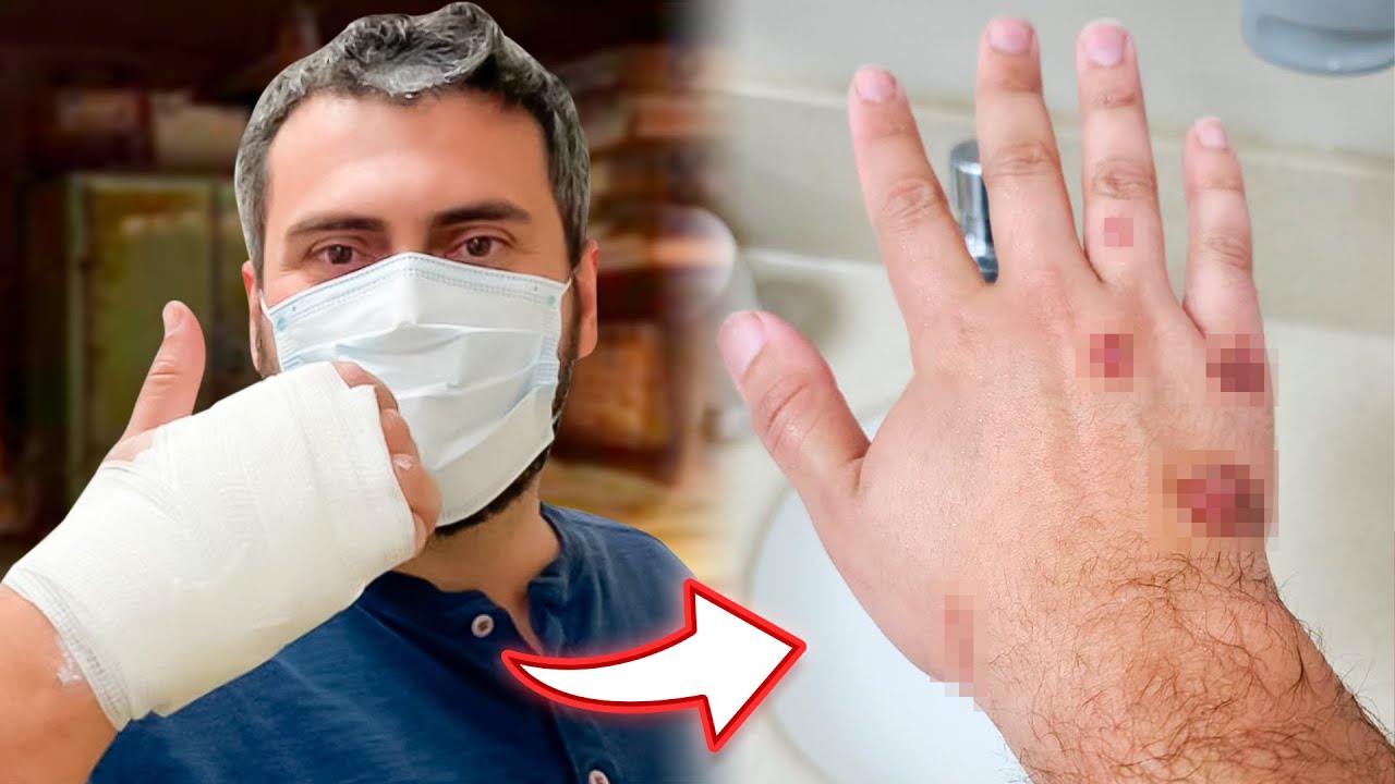 Mão Machucada De Soco - RETOEDU