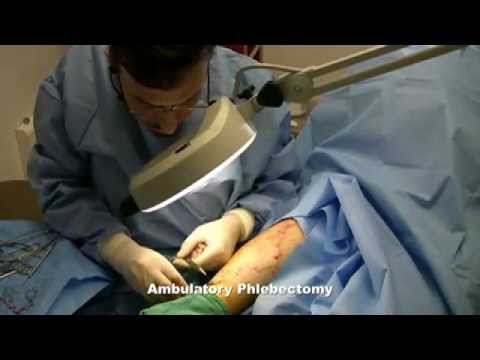 Ambulatory Phlebectomy - YouTube