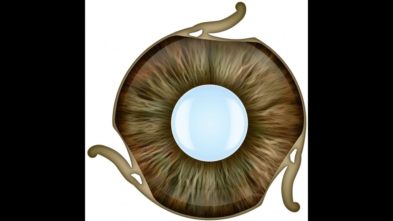 Artificial iris and intraocular lens implantation ( MIOL - IRIS ...