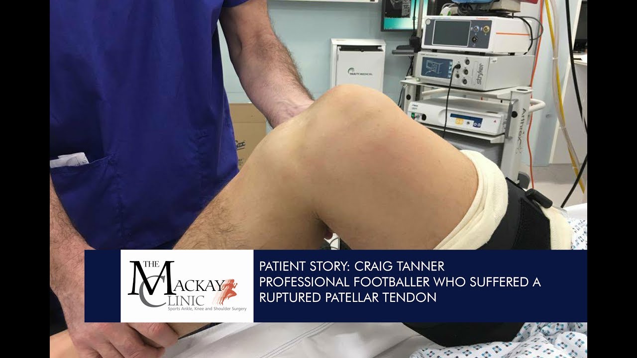 Footballers serious knee injury repaired with Internal Bracing # ...