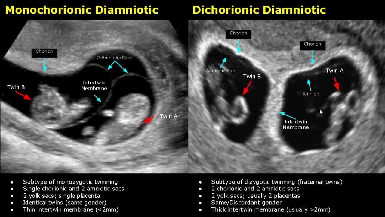 Fetal Twins Ultrasound Normal Vs Abnormal Monochorionic Dichorionic Fetal Twins Ultrasound Normal Vs Abnormal Monochorionic Dichorionic