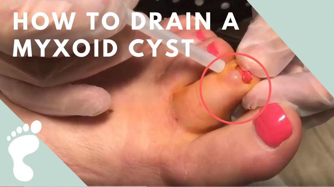 HOW TO DRAIN A MYXOID CYST ON THE TOE YouTube