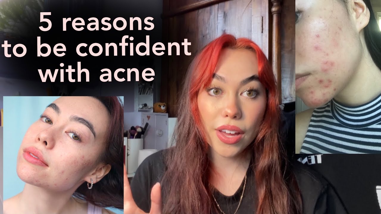 how to be confident with acne! - YouTube