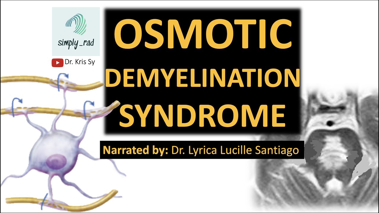 Osmotic demyelination, pontine & extrapontine myelinolysis - simplified ...
