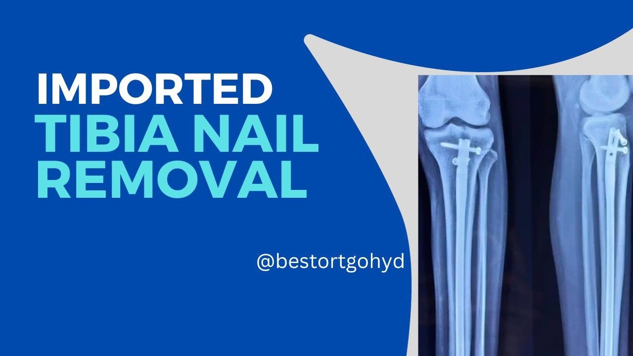 IMPORTED TIBIA NAIL REMOVAL DONE AFTER 2 YEARS OF INDEX SURGERY WITH ...
