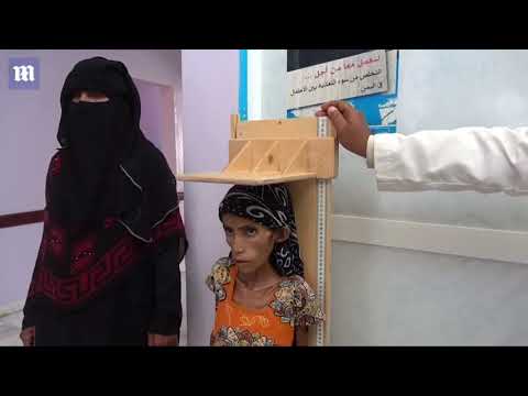Starving girl shows the effects of the Yemen war on people - YouTube