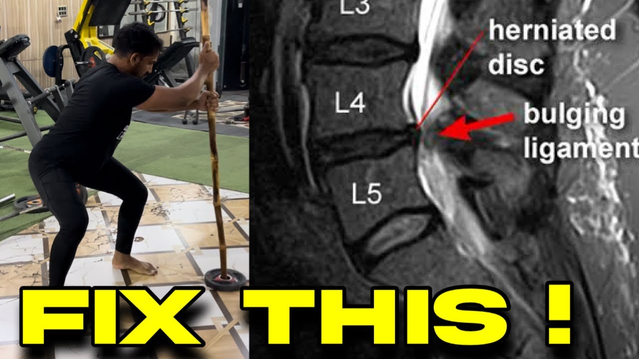 Fix This L4 L5 Disc Bulge Herniation 3 Exercises Resolve