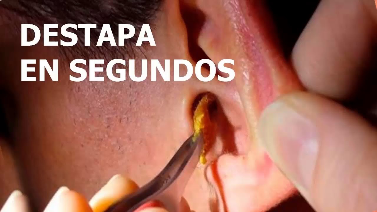 Increíble, Como se Destapan tus Oídos en Segundos Con Este Remedio ...