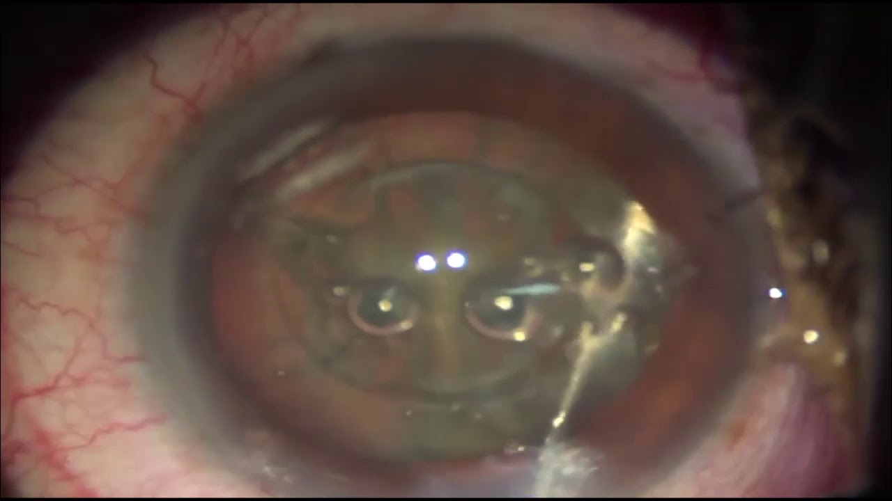 Pupillary Zone Sparing Partial Corneal Epithelium Debridement For C3R ...