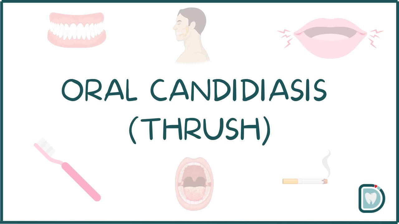 Understanding Oral Candidiasis or Oral Thrush - YouTube