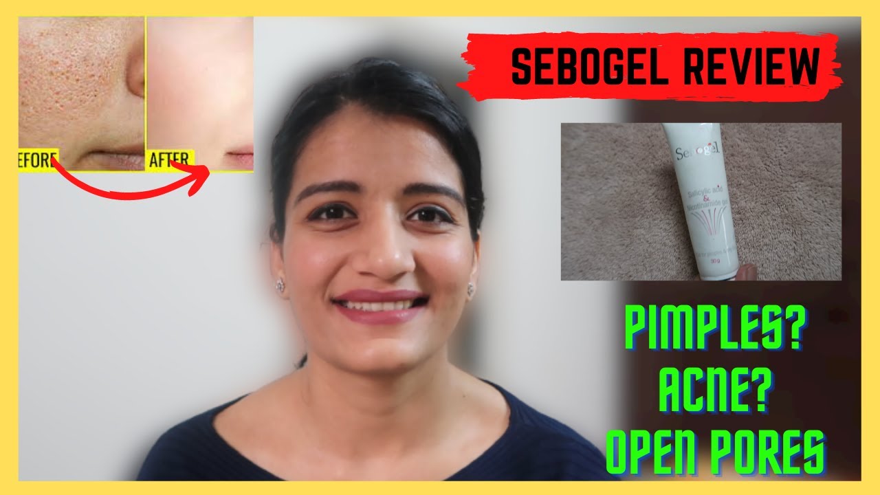 Best Gel For Acne/Pimple Sebogel : Full Review + Application - YouTube