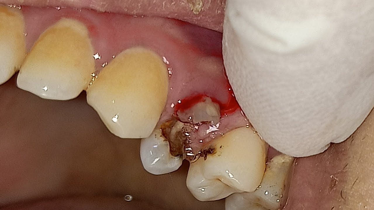 remove broken upper Premolar - YouTube