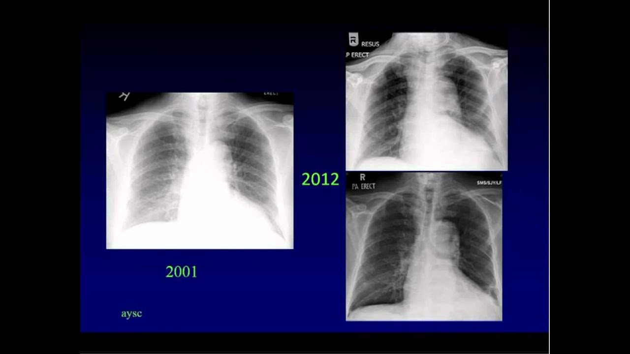 Presentation on Acute Aortic Syndromes by Prof. Lenny Tan - YouTube