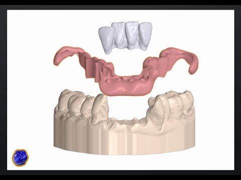 B4D Dental Modules-Zoom Immediate Partial - YouTube