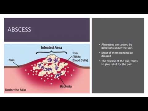 Abscess on back - YouTube